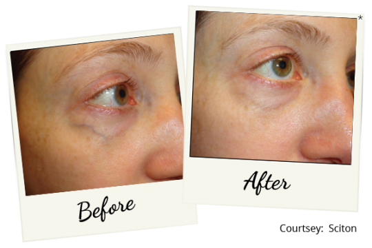 Clear V™ – Marin Medical Aesthetics