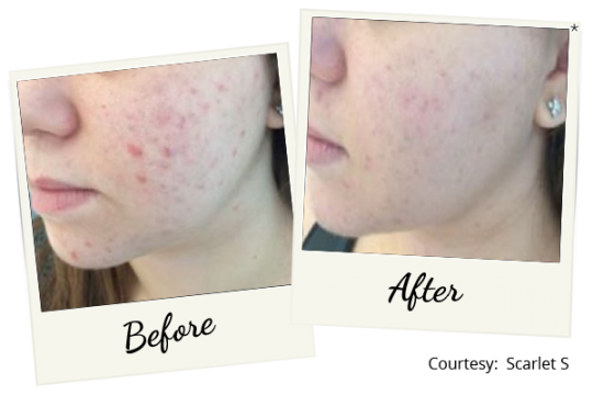 ScarLet® – Marin Medical Aesthetics