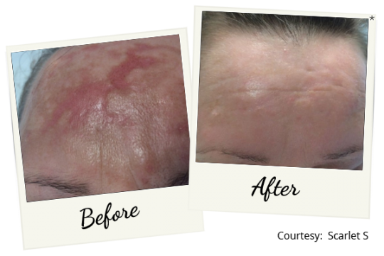 ScarLet® – Marin Medical Aesthetics